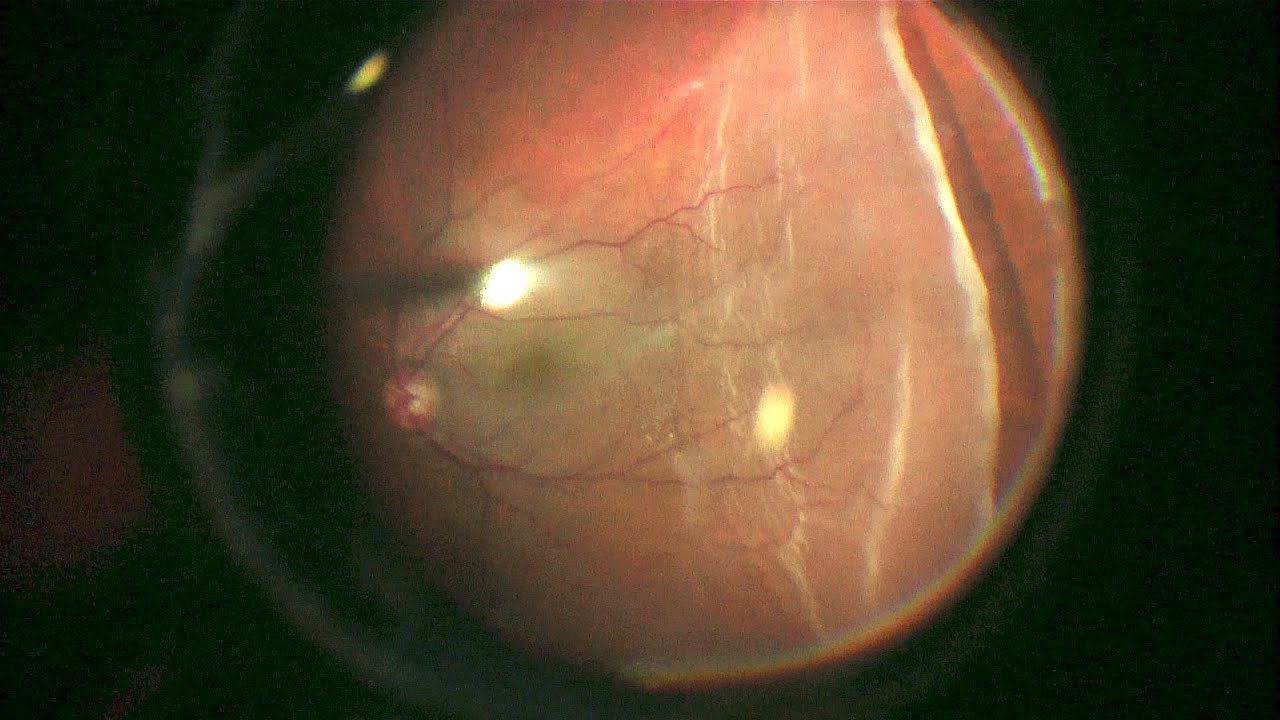 Giant retinal tear (GRT) associated retinal detachment managed with 25G ...