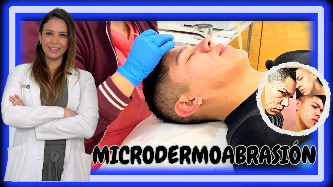 MICRODERMOABRASIÓN FACIAL: Combate el ACNÉ con este TRATAMIENTO I JAVIER DERMA - YouTube