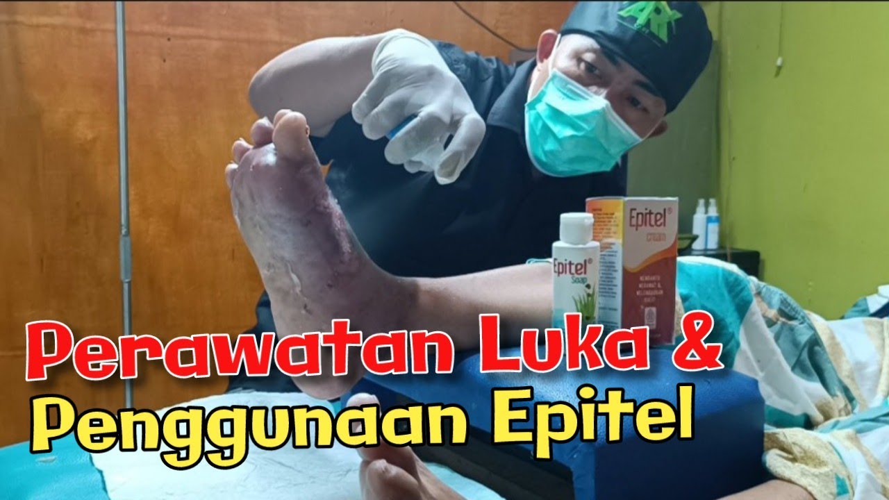 Perawatan luka dengan penggunaan epitel - YouTube