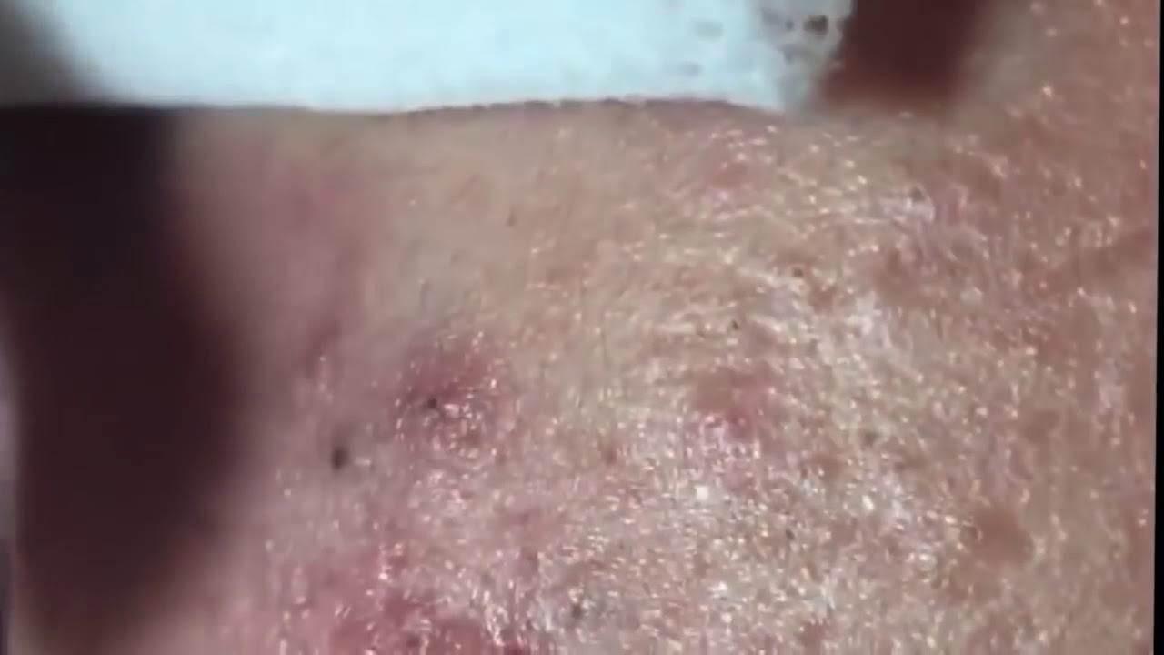 Big Blackheads Extraction By Removal Tool Acne Treatment - YouTube