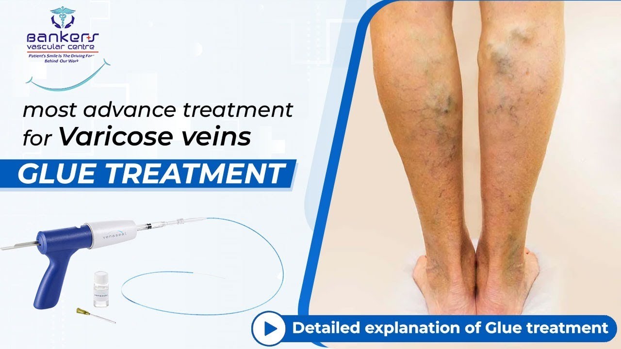 Glue Treatment For Varicose Veins By Dr Mohal Banker Youtube
