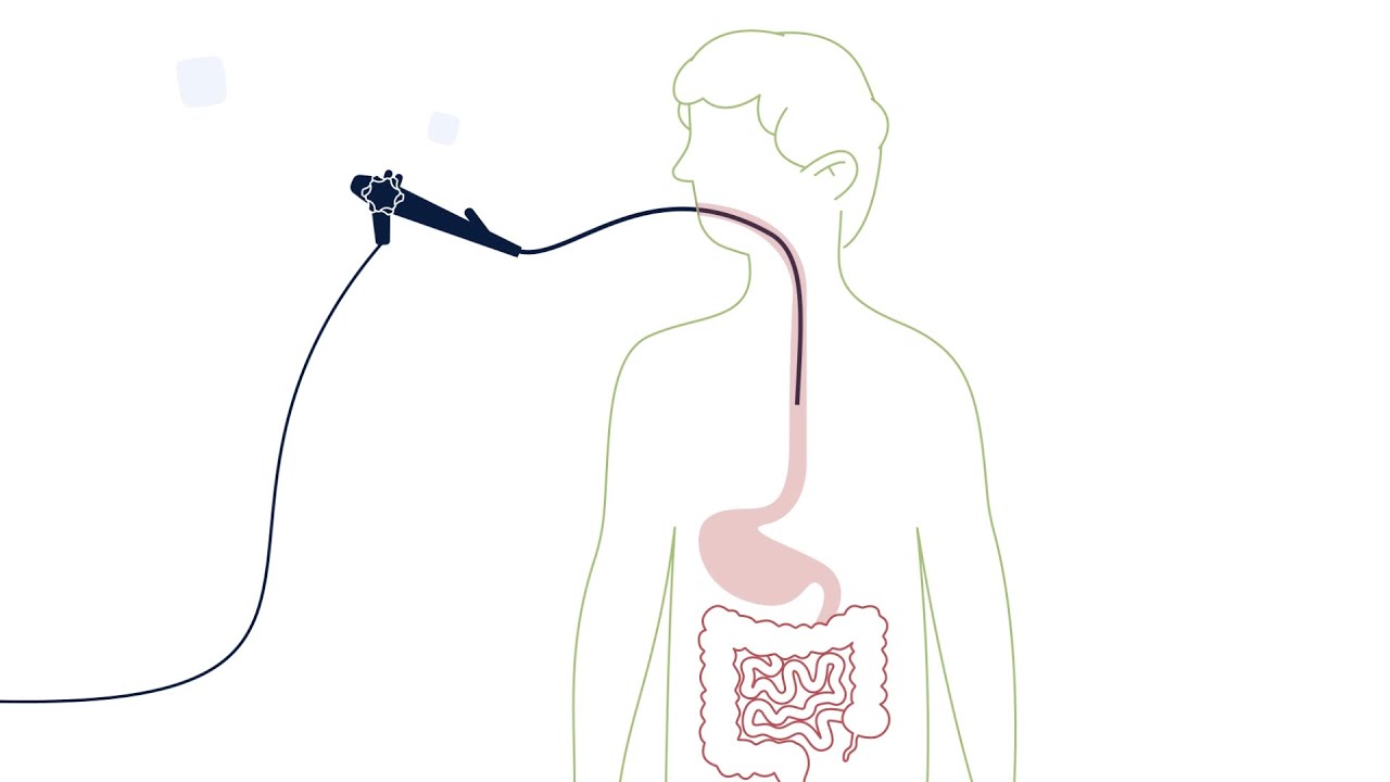 What is an Esophagogastroduodenoscopy (EGD) - YouTube