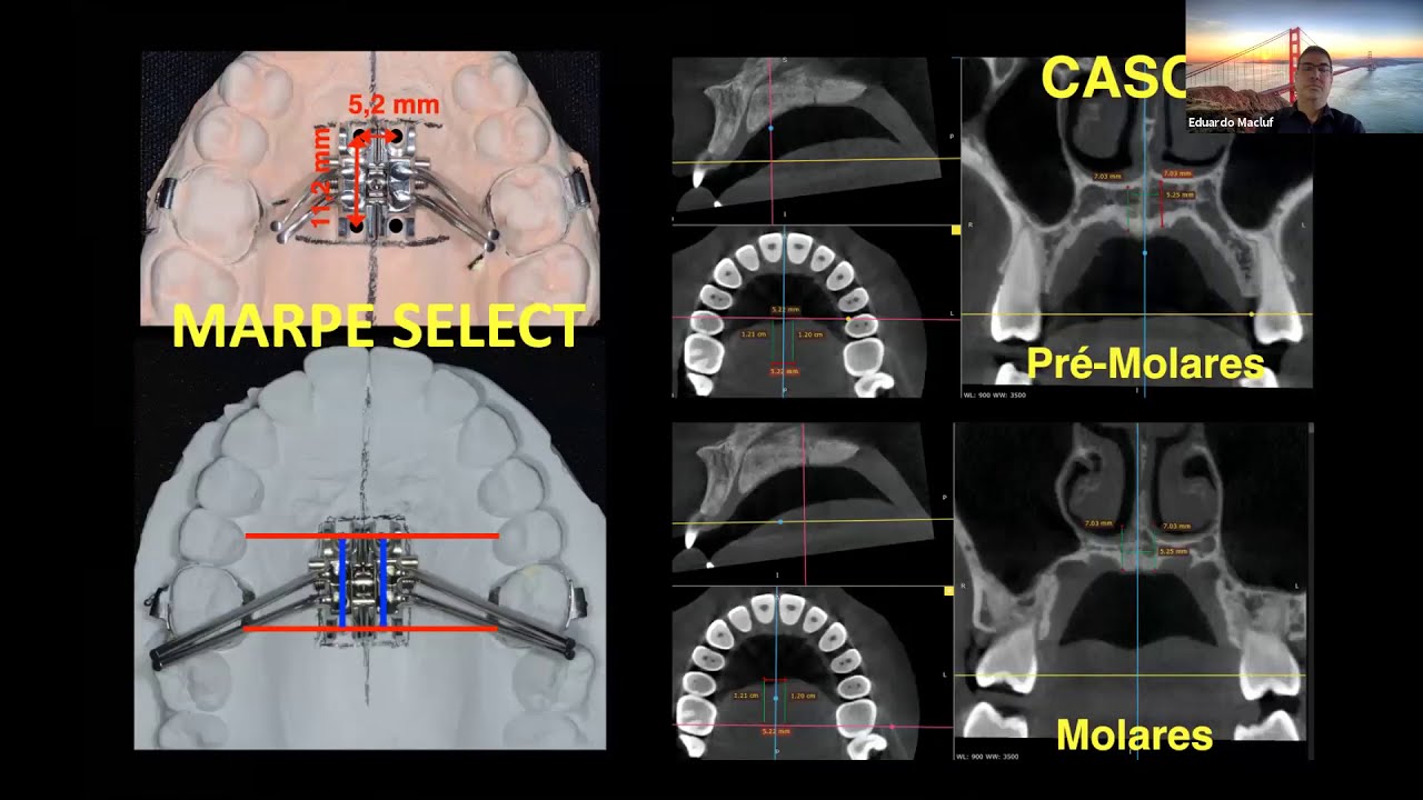 MARPE CLASE 2 - YouTube