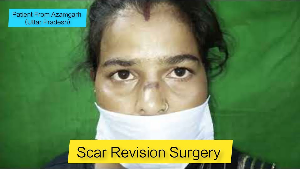 Scar Removal | Scar Revision Surgery | Scar Revision Surgery Cost ...
