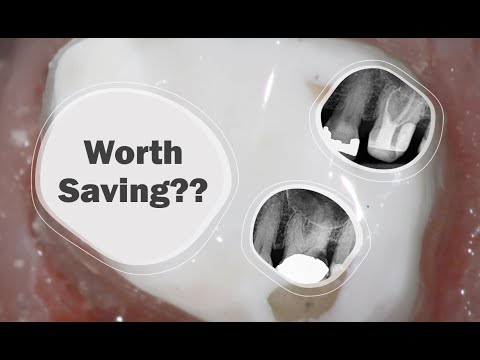Broken Down Molar Root Canal - YouTube