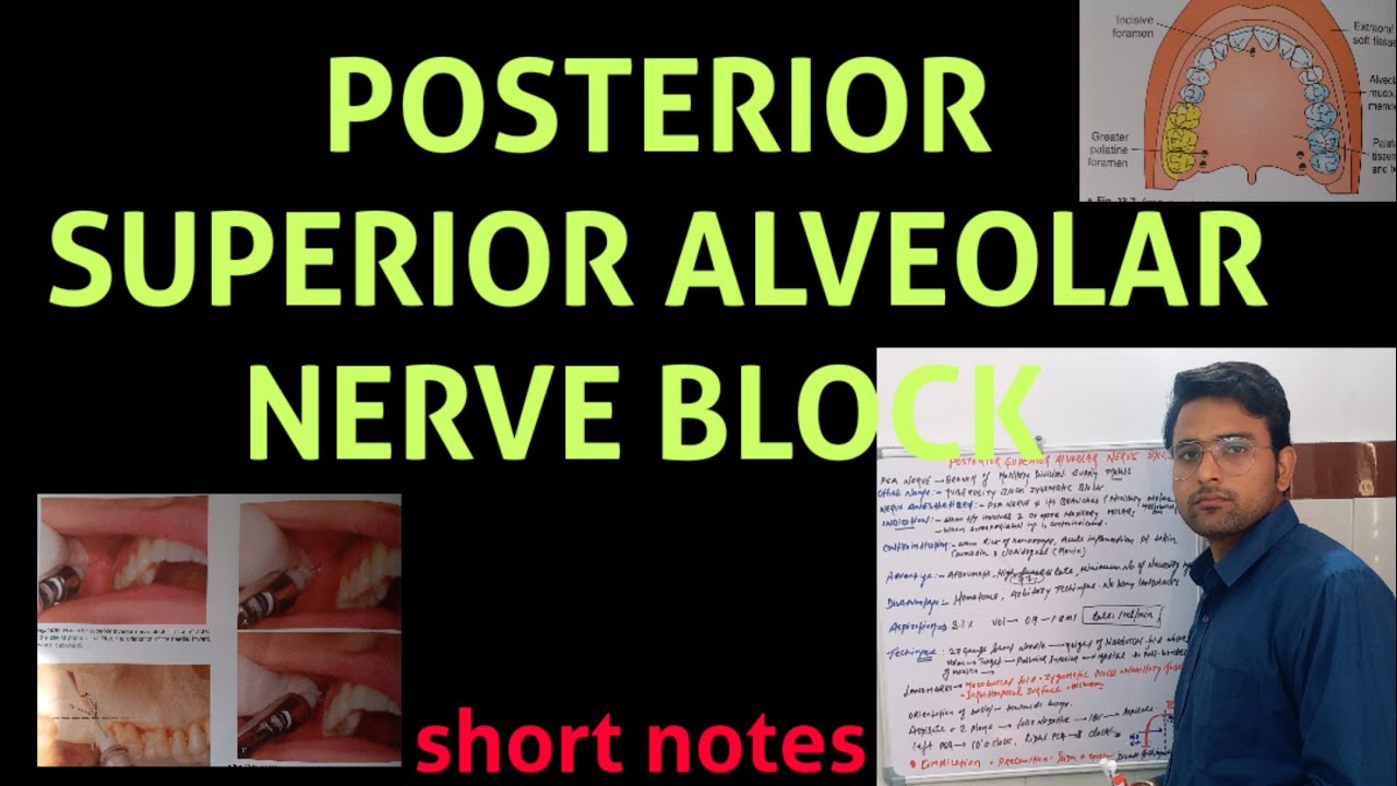 Posterior superior alveolar nerve block - YouTube