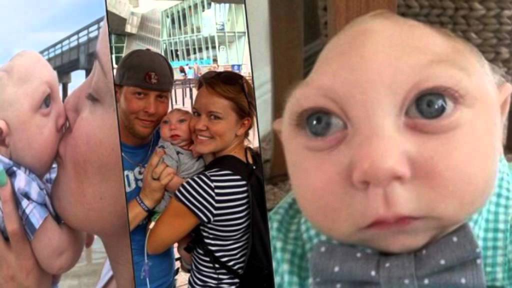 Nace niño con medio cerebro "Lisencefalia" - YouTube