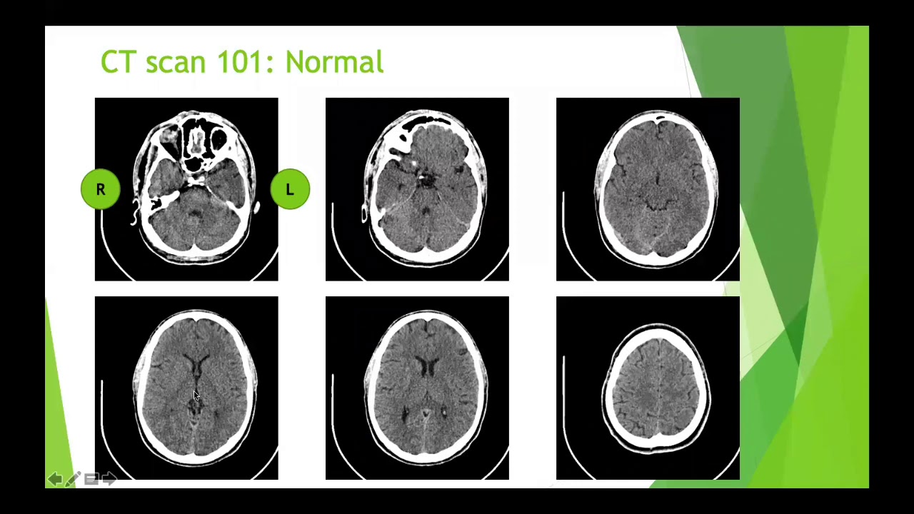 TBI in the ICU by Dr Christel Arnold Day. - YouTube