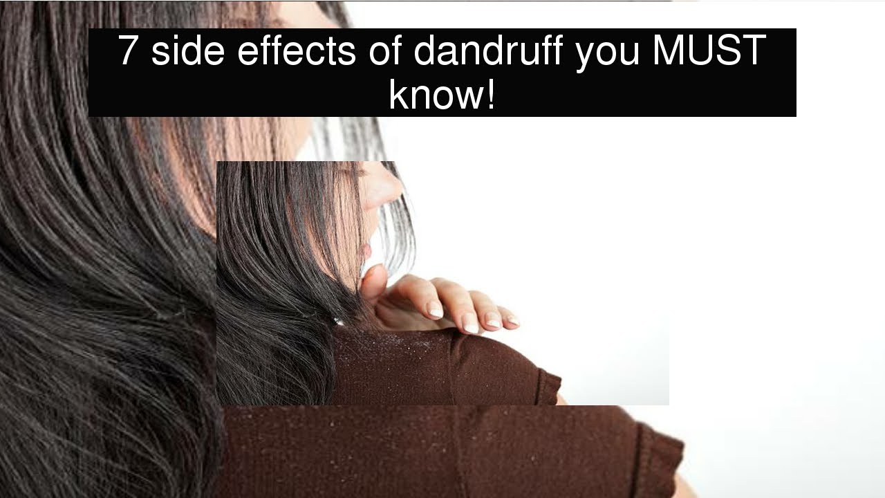 7 side effects of dandruff you MUST know! - YouTube