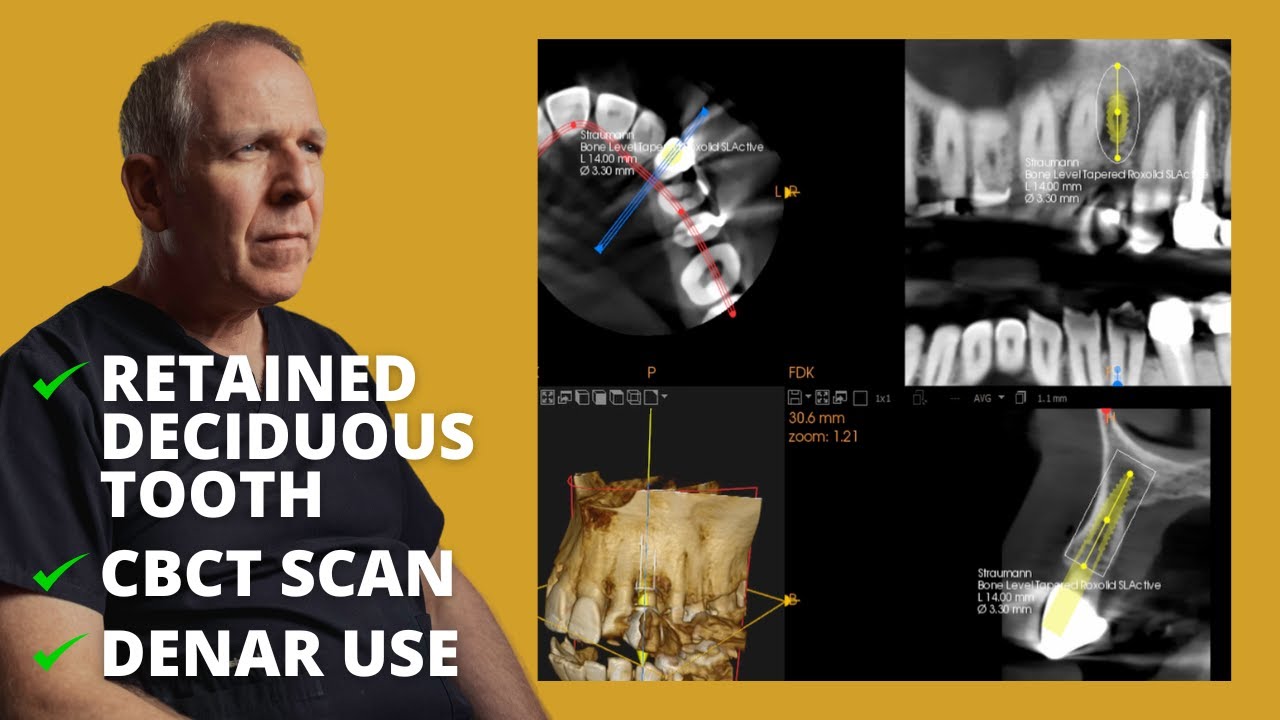 Implant Planning using CBCT - Dentistry Case by Dominic Hassall - YouTube
