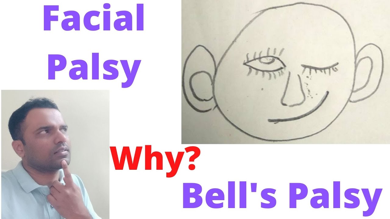 Bell's palsy (Facial Palsy) Paralysis of Facial Muscles, deviation of ...