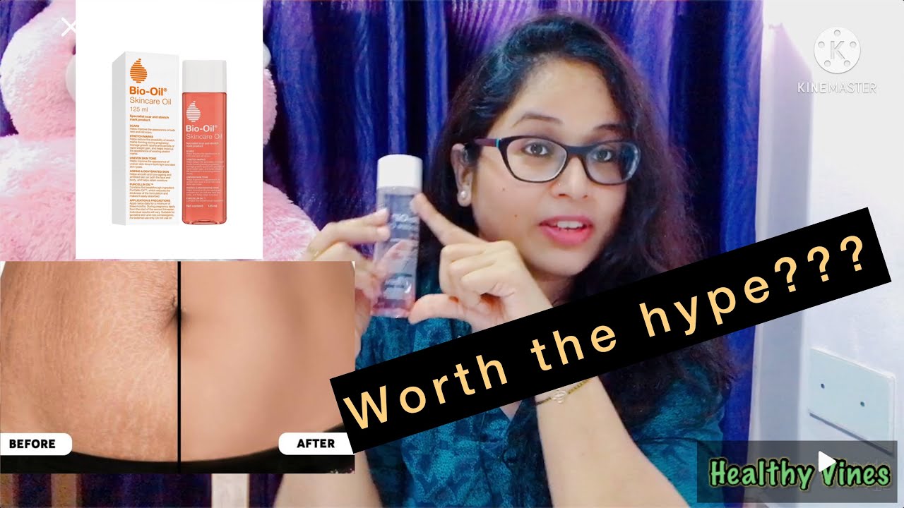 My honest review of bio oil for stretch mark..Does it work??? All ...