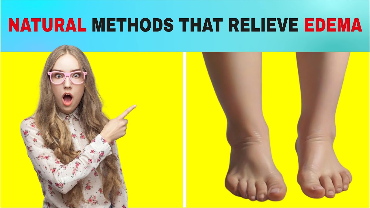 NATURAL METHODS THAT RELIEVE EDM | FLUID ACCUMULATION | EDEMA SYMPTOMS ...