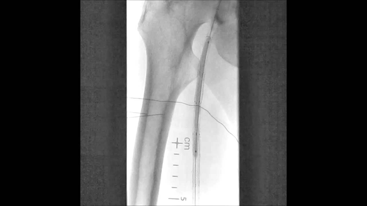 In-stent SFA occlusion treated with laser and PTA - YouTube