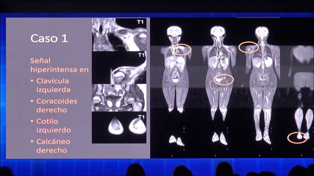 Resonancia magnética de cuerpo entero en pediatría. Inés Mannes - YouTube
