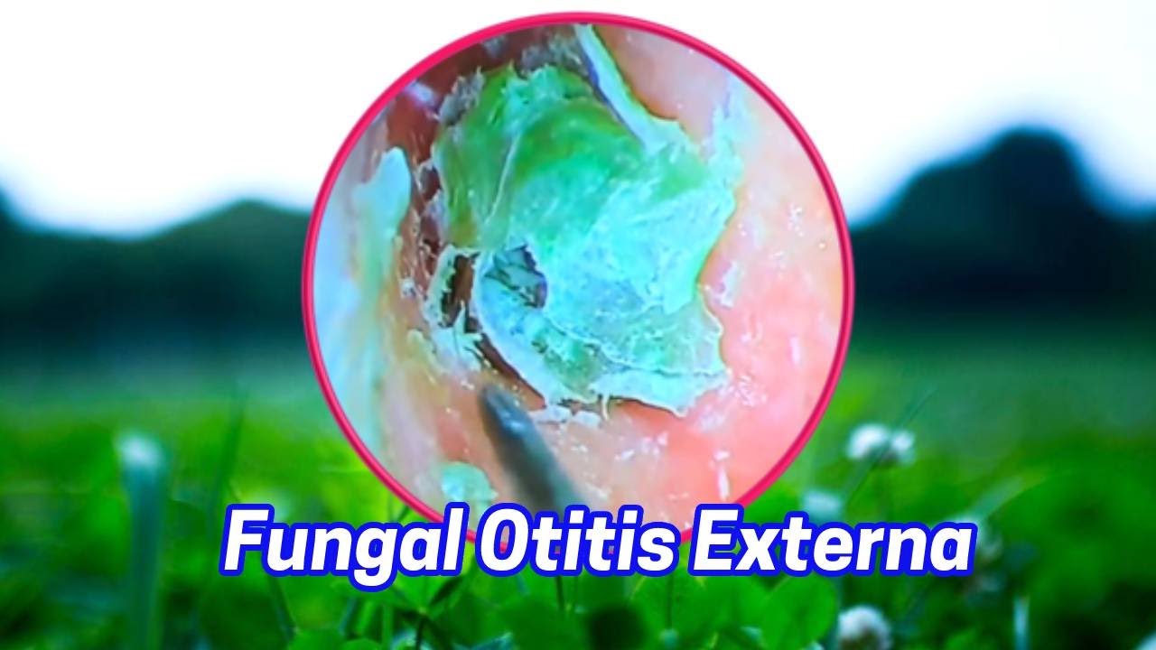Fungal otitis externa, the tympanic membrane is not blocked at all, and ...
