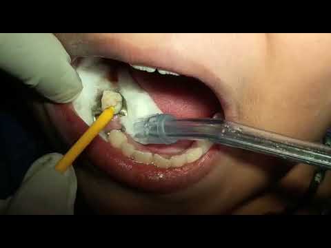 SDF Application for Prevention of Caries in children - YouTube