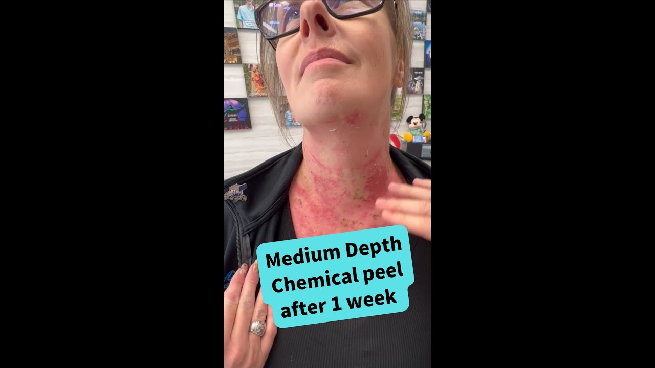 Medium Depth Chemical Peel at the dermatologist - YouTube
