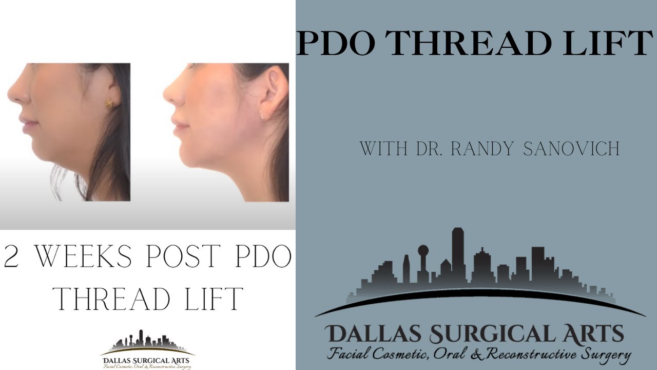 PDO Thread Lift (Non-Surgical Jaw Contouring) with Dr. Randy Sanovich ...