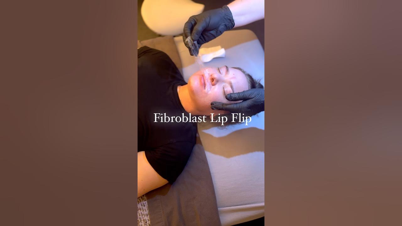 Fibroblast Plasma Lip Flip💋A wonderful all natural alternative to injections #fibroblast # ...
