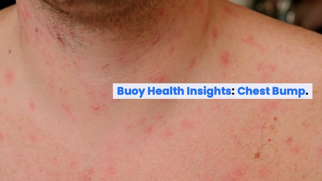 Chest Bump: Common Causes and When to Seek Medical Care | BuoyHealth ...
