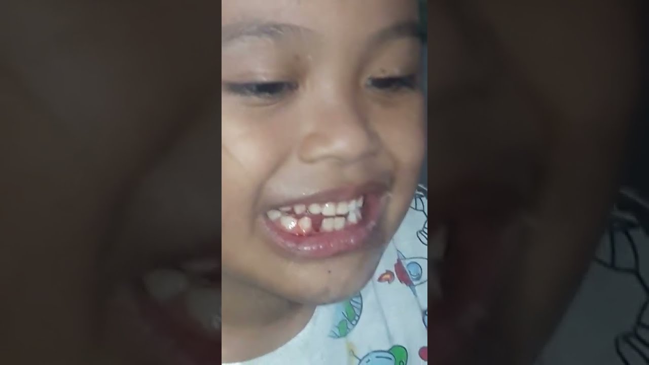 DIY baby tooth extraction | How to pull a baby tooth at home | painless ...