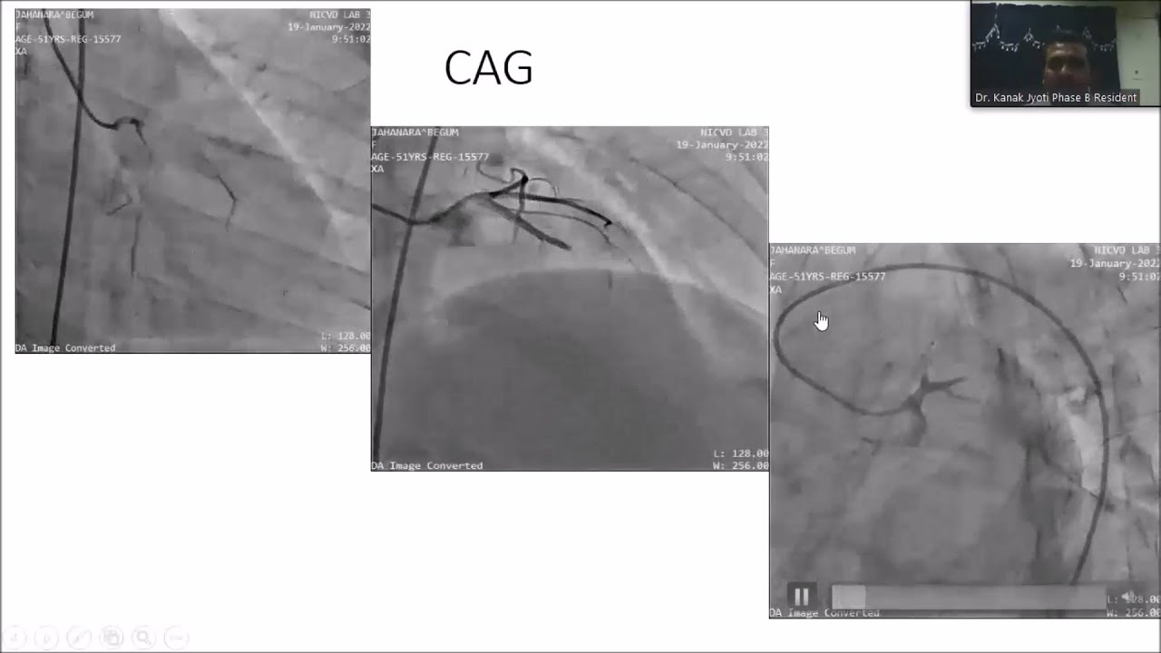 Intervention Presentation (Coronary Artery Spasm) - YouTube