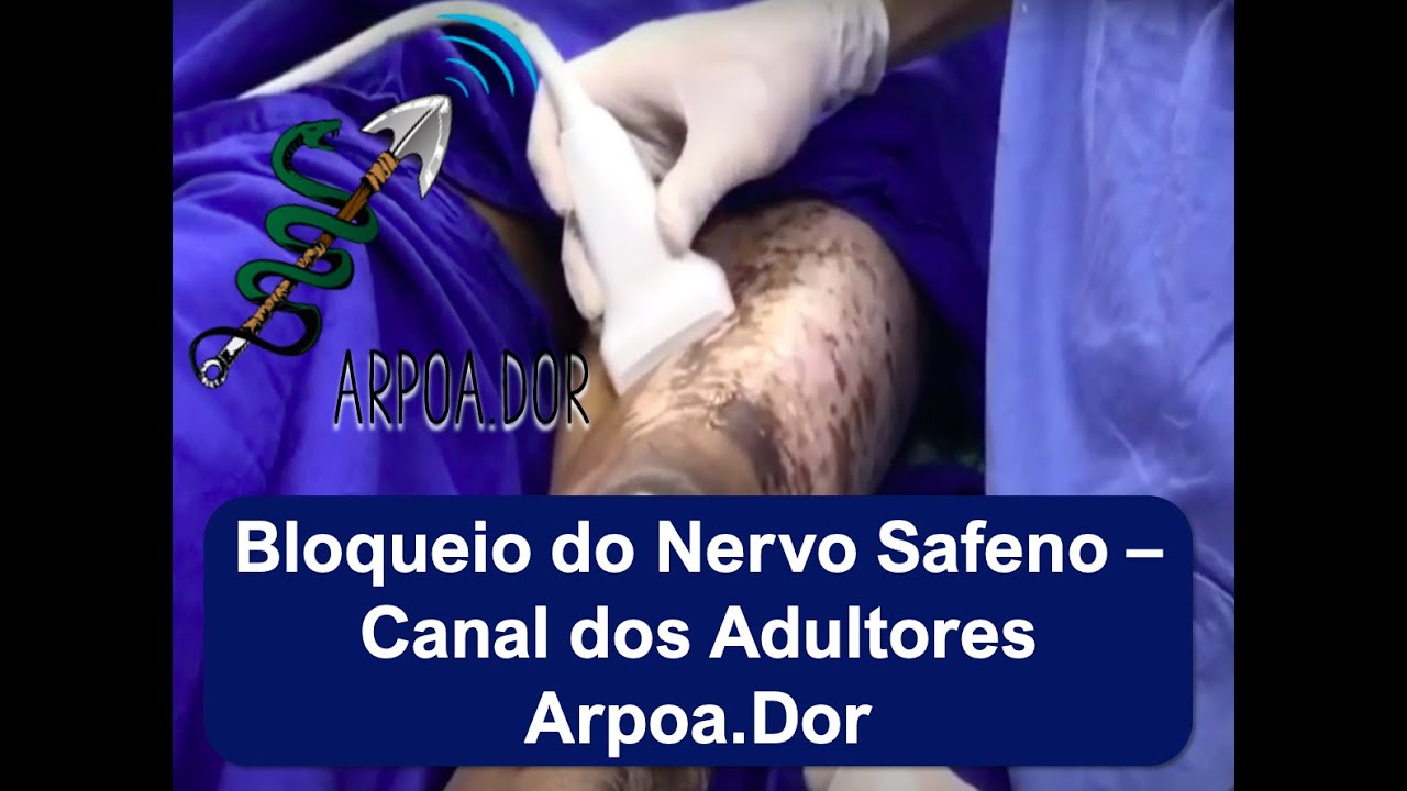 Bloqueio de Nervo Safeno Guiado por US - YouTube