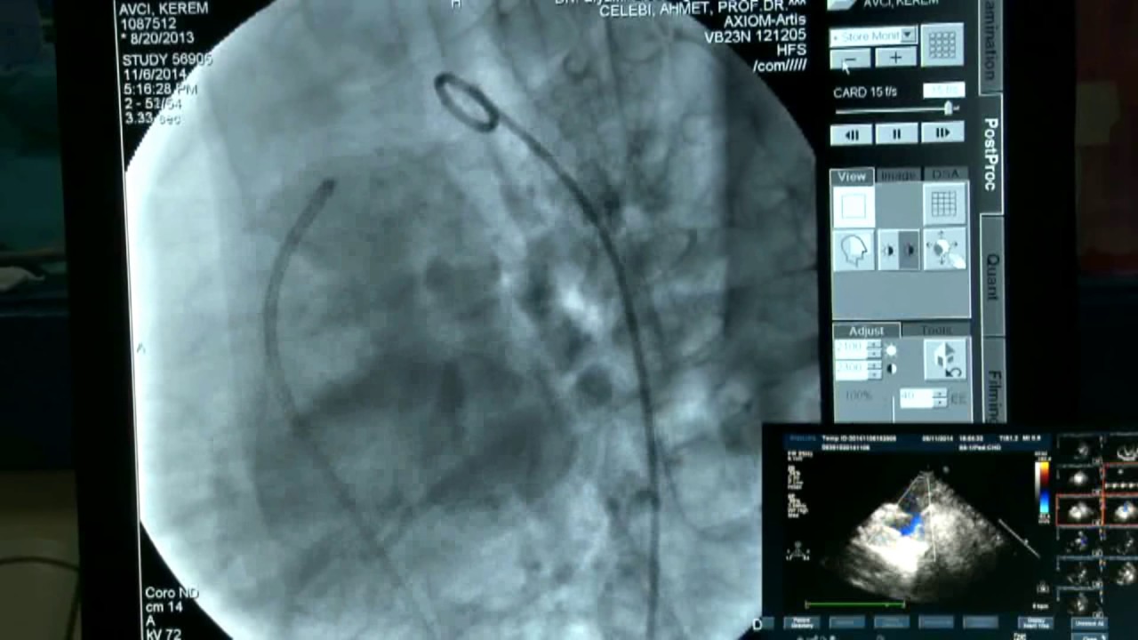 LIVE CASE 11 PDA closure with Amplatzer ADO Yalım Yalçın, Abdullah ...