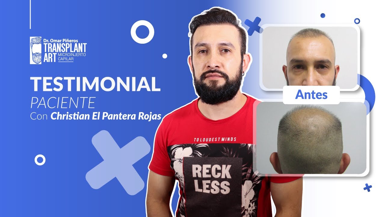 PROCESO DEL TRASPLANTE CAPILAR - CHRISTIAN EL PANTERA ROJAS👨🏻‍🦱 (ACTOR ...