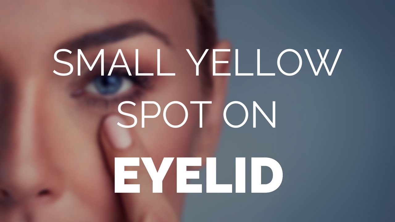 Small yellow spot on eyelid, is it Xanthelasma or Xanthoma? - YouTube