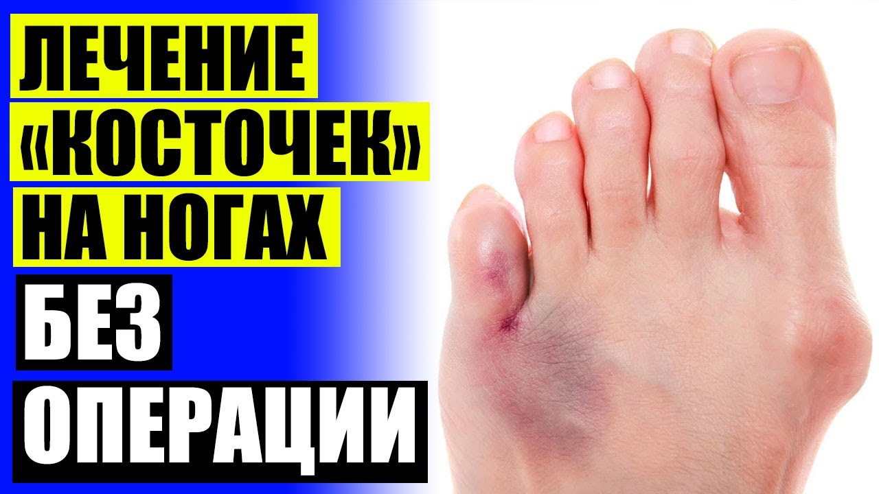 👣 Косточка на ноге упражнения Косточка на большом пальце ноги народные