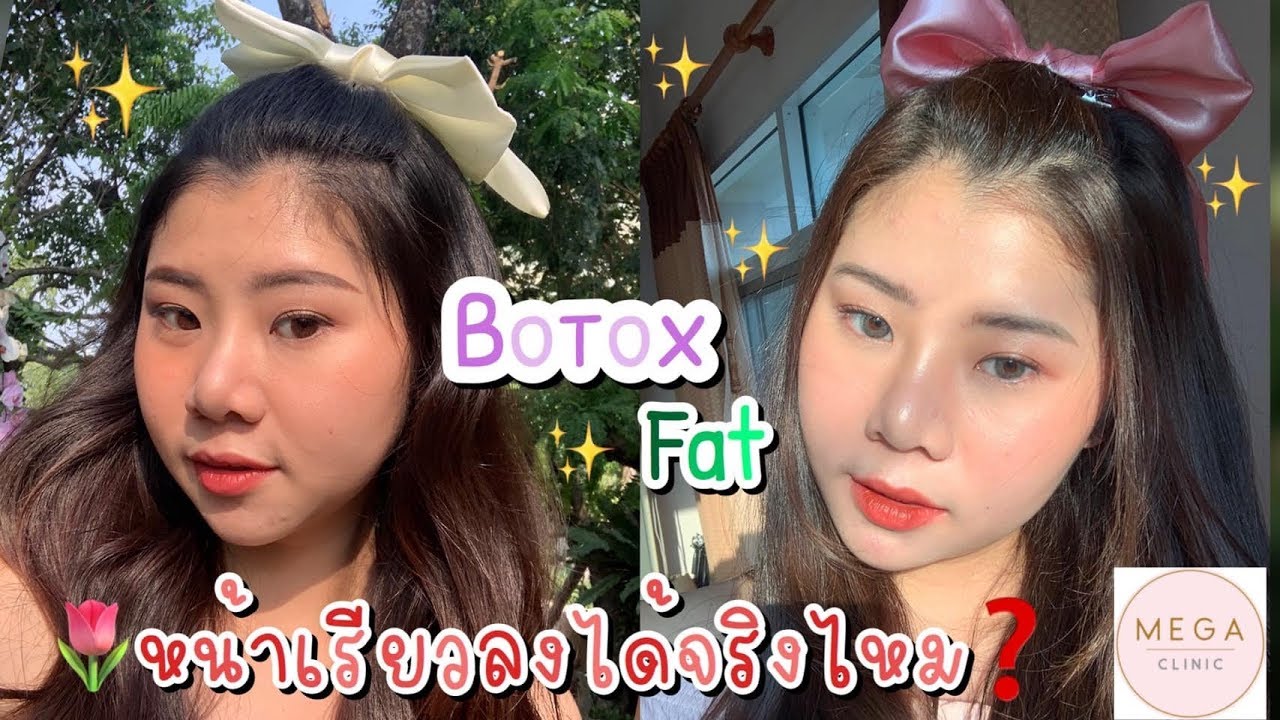 Botox Fat หน้าเรียวได้จริงหรือไม่ ? ครั้งแรกกับ #Megaclinic - YouTube