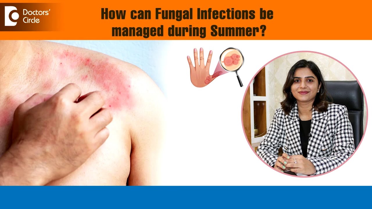 Summer #skin Issues | Fungal Infection Prevention, and Treatment ...