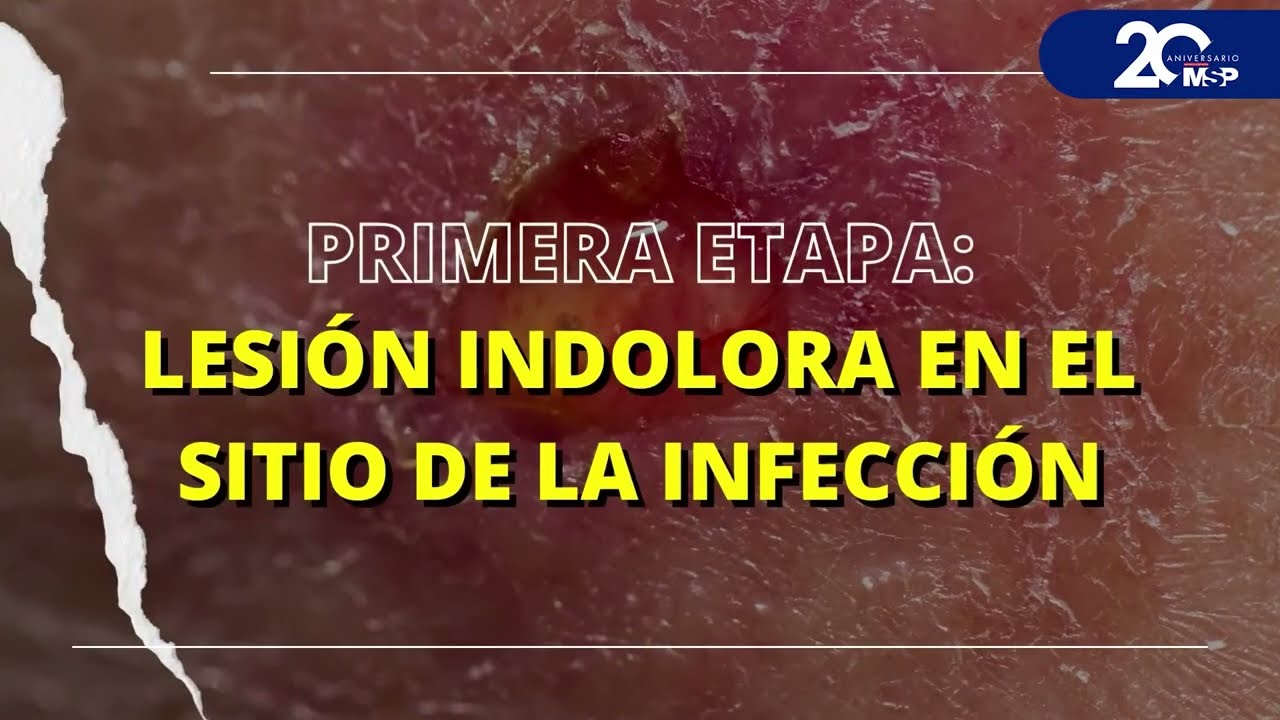 ¿Cómo funcionan las 3 etapas de la sífilis en el cuerpo? - # ...