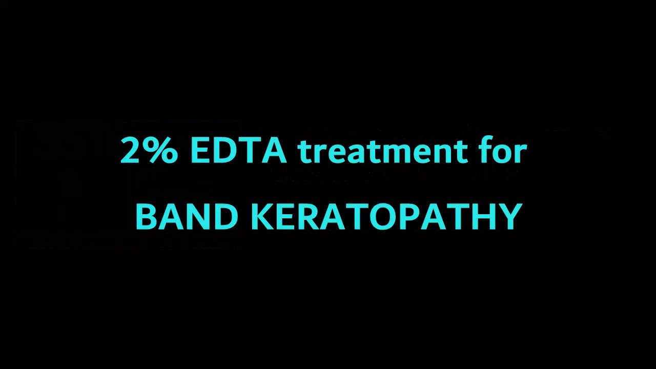 BAND KERATOPATHY TREATMENT WITH 2% EDTA SOLUTION - YouTube