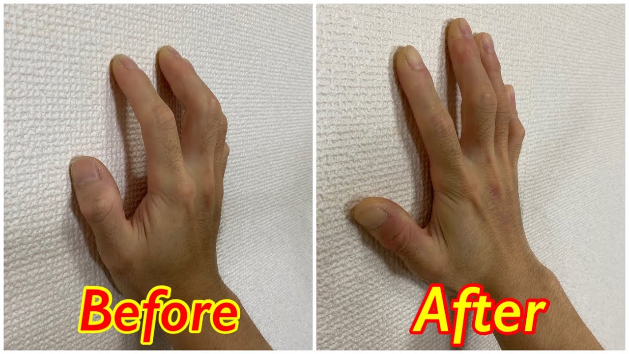 How to treat tight hand and fingers (English) - YouTube