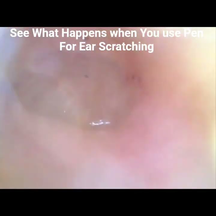 See What Happens when You Use Pen For Ear Scratching | Ear Care Warning ...