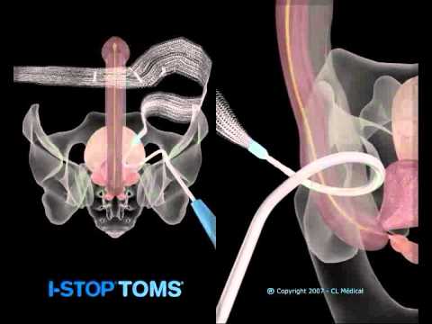 I-STOP TOMS 3D animation for male urinary incontinence