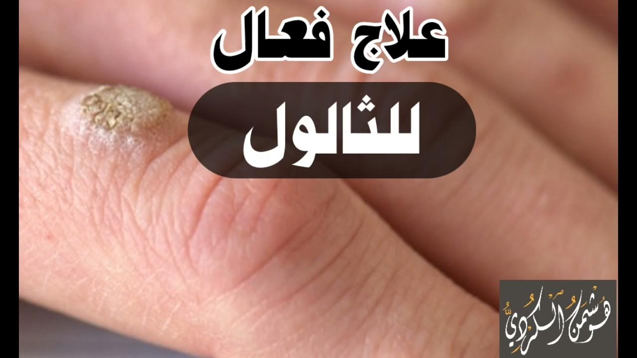 طريقة مجربة لعلاج الثالول أو الفالول|بالقرآن والسنة| (هوشمن الكردي ...