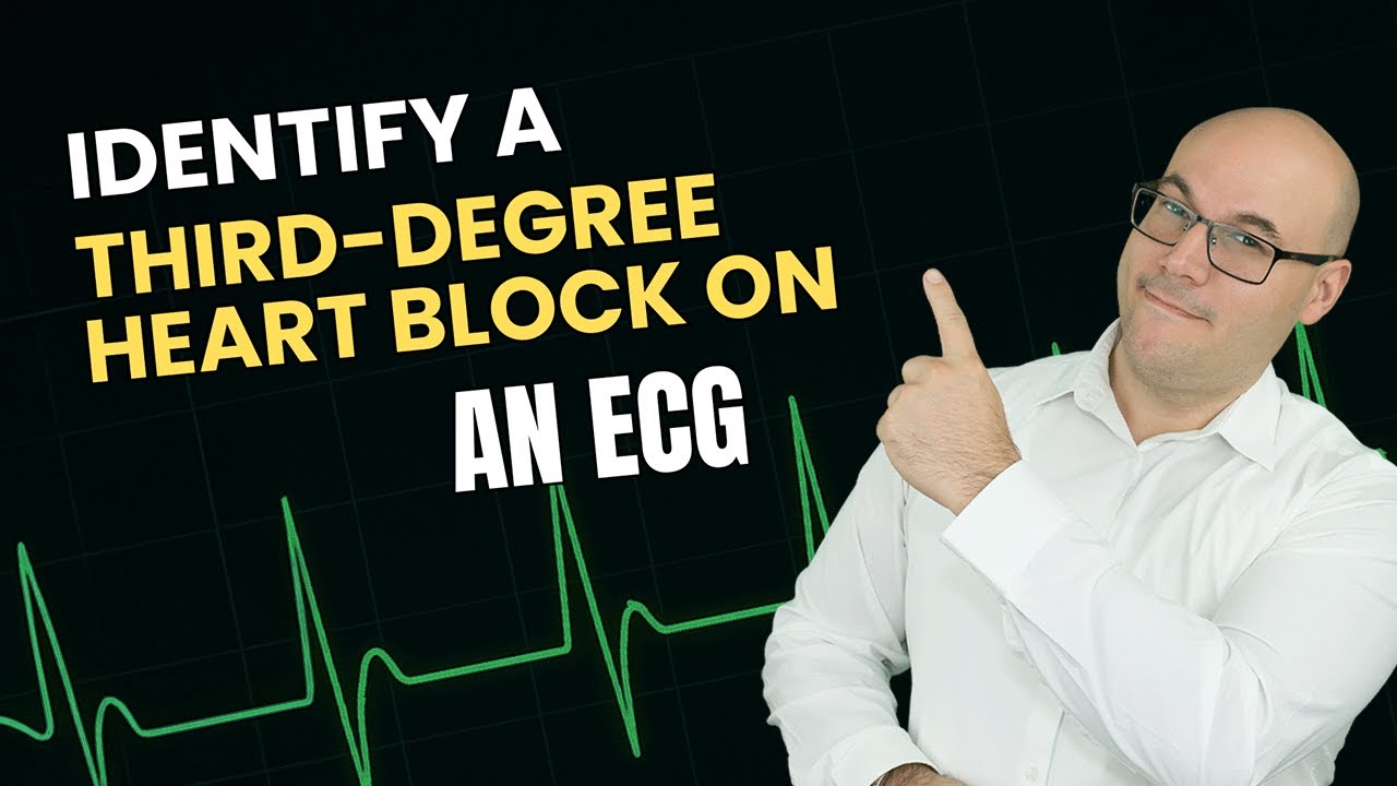 How to Identify a Third-Degree Heart Block on an ECG? - YouTube