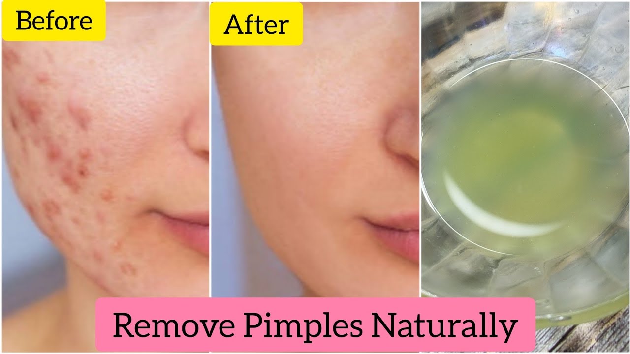 How to Removes Pimples Naturally with in 7 Days : Best Homemade Toner ...