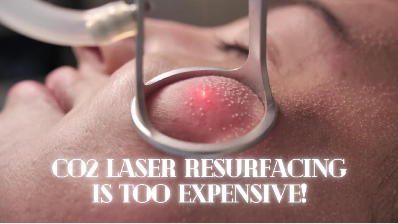 CO2 Laser Resurfacing Common Myths Busted - Transcend Rejuvenation ...