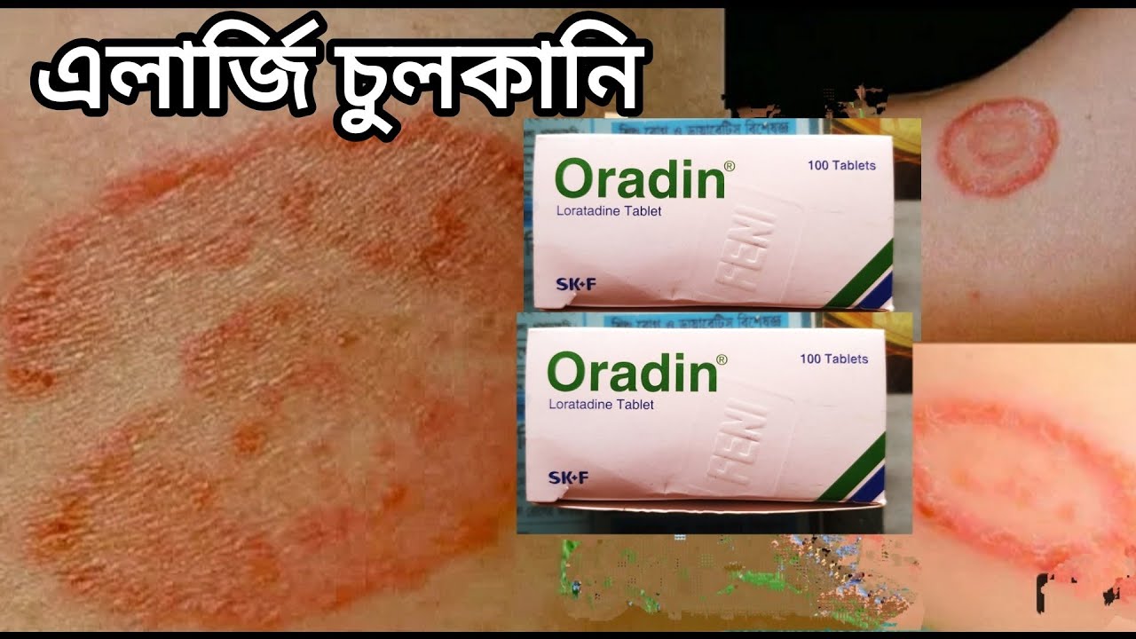 oradin 10 mg. এলার্জি চুলকানি. Allergic itching. - YouTube