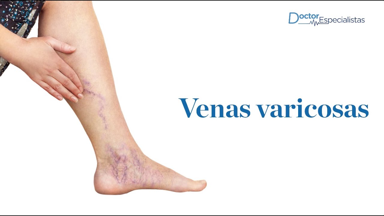 Venas varicosas - Doctores Especialistas - YouTube