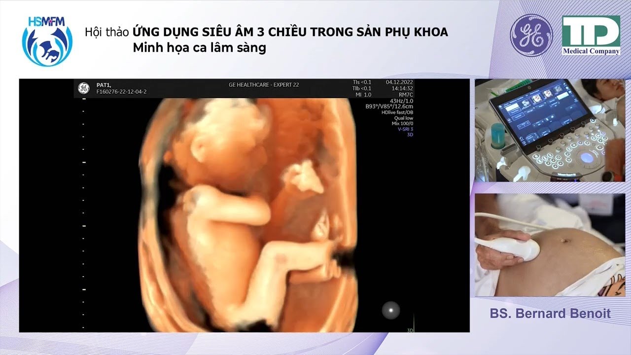 6. Thực hành siêu âm 3D ca bệnh lý - BS. Bernard Benoit - YouTube