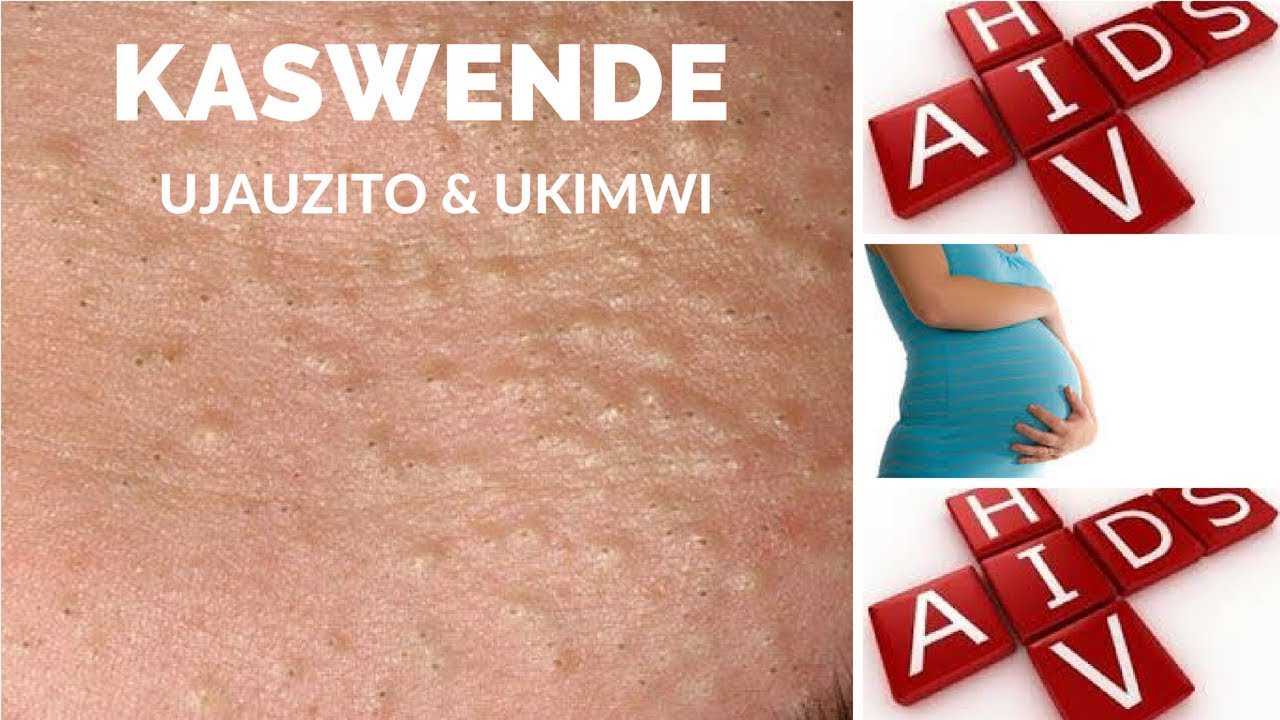 Uhusiano wa Kaswende na Ujauzito & UKIMWI - Kaswende #3 - YouTube