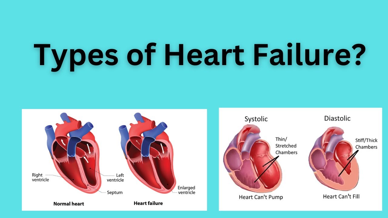 Types of Heart Failure? - YouTube
