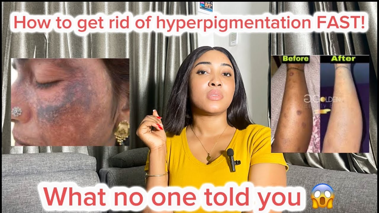 HOW TO GET RID OF FACE AND BODY HYPERPIGMENTATION - YouTube