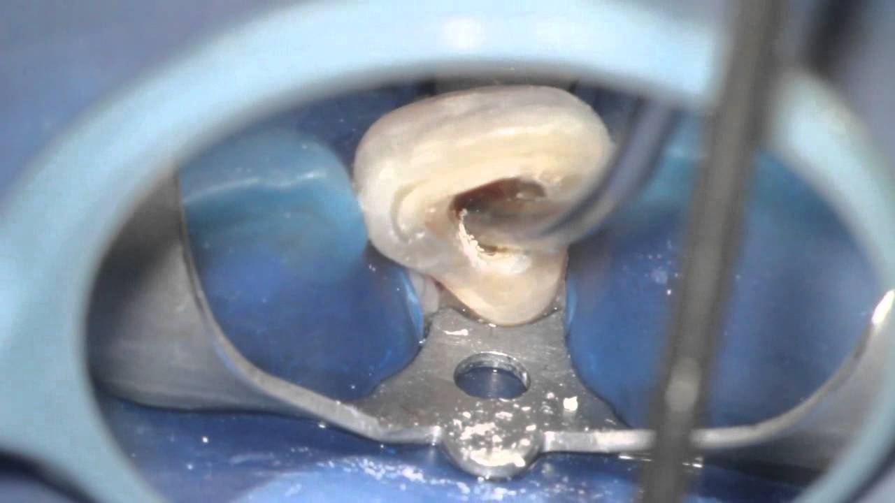 MTA Apical Plug with CollaCote - YouTube